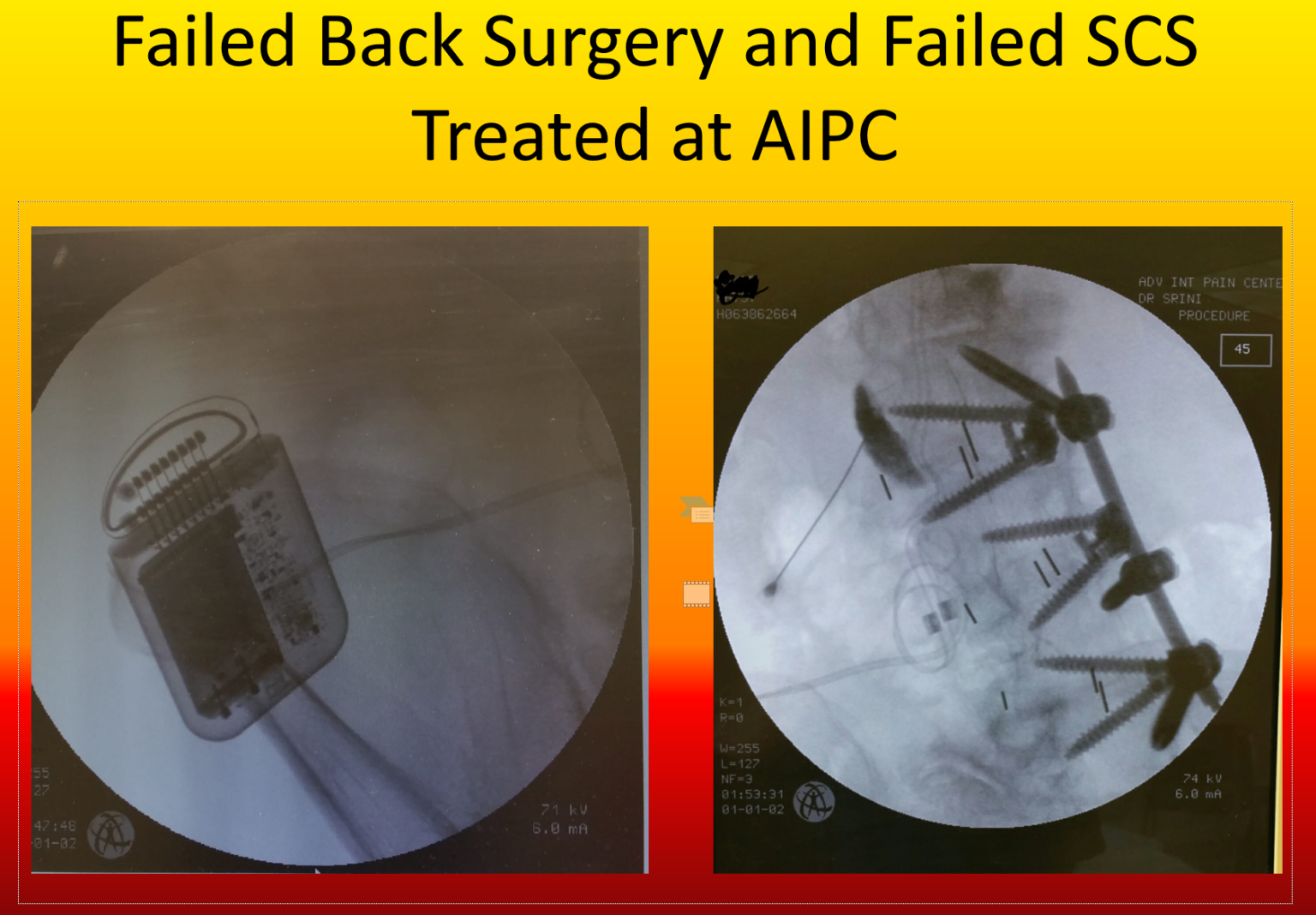 World's No.1 Interventional Pain Center - Advanced Interventional Pain ...